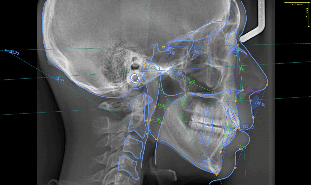 Cephworx - Cephalometric Tracings Made Easier with Less Work!